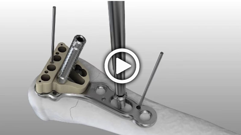 Acu-Loc 2 Volar Distal Radius Surgical Technique | Acumed