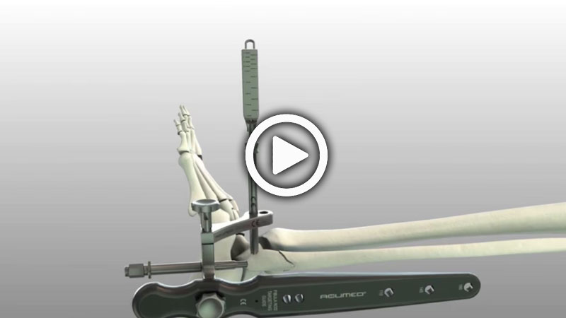 Fibula Rod System Animated Surgical Technique | Acumed