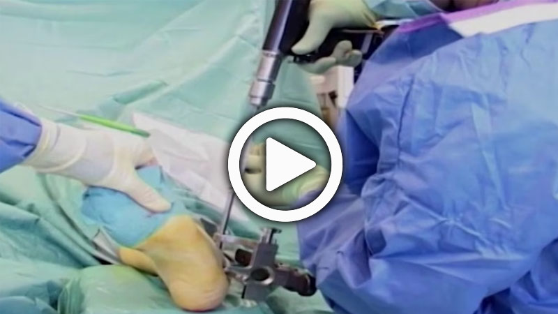 Fibular Rod Operative Technique | Acumed