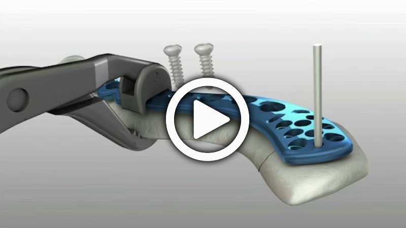 Locking Superior Distal Clavicle Plates Surgical Technique | Acumed