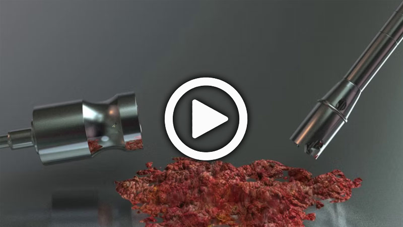 Bone Graft Harvesting System | Acumed