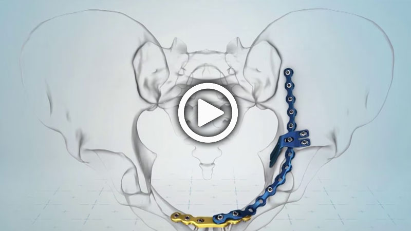Pelvic Plating System Overview | Acumed