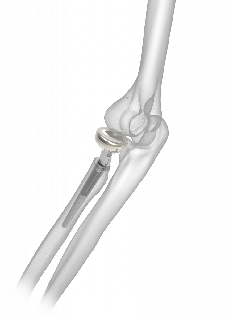 Anatomic Radial Head Solutions | Acumed