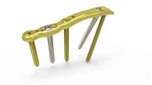 Divergent Radial Styloid Plate | Acumed