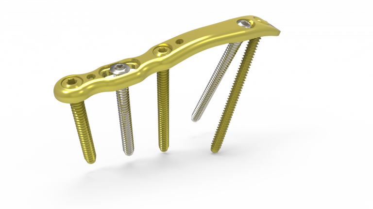 Divergent Radial Styloid Plate | Acumed