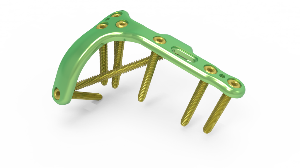 Acu-Loc 2 Wrist Plating System | Acumed