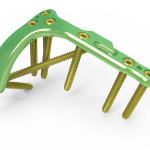 Acu-Loc 2 Wrist Plating System | Acumed