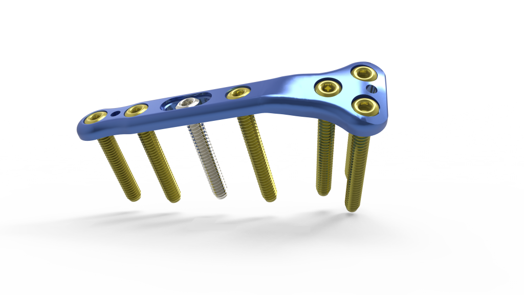 Acu-Loc 2 Wrist Plating System | Acumed