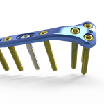 Acu-Loc 2 Wrist Plating System | Acumed