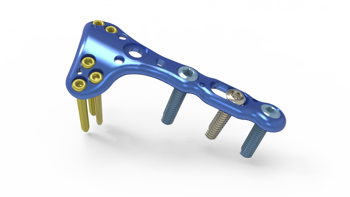 Dorsal Distal Radius Plate | Acumed