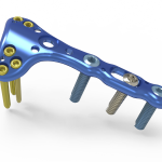 Acu-Loc Wrist Plating System | Acumed