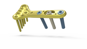 Acu-Loc Wrist Plating System | Acumed