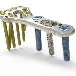 Acu-Loc 2 Wrist Plating System | Acumed