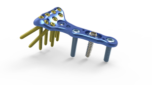 Acu-Loc Wrist Plating System | Acumed