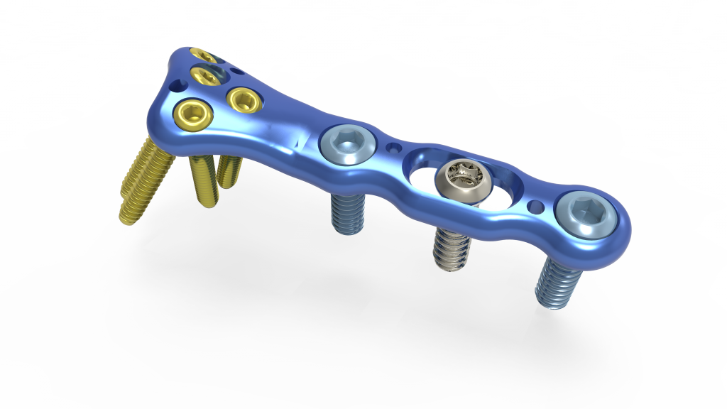 Acu-Loc Wrist Plating System | Acumed