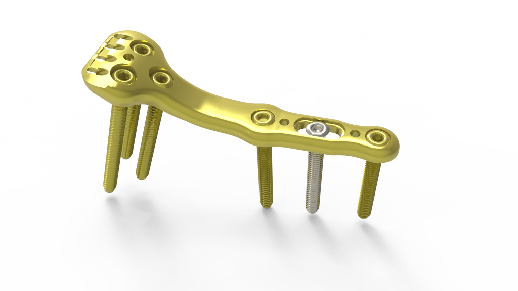 Acu-Loc 2 Wrist Plating System | Acumed