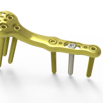 Acu-Loc 2 Wrist Plating System | Acumed