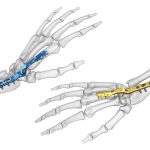 Total Wrist Fusion Plating System | Acumed
