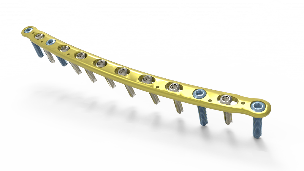 Midshaft Volar Radius Plate | Acumed