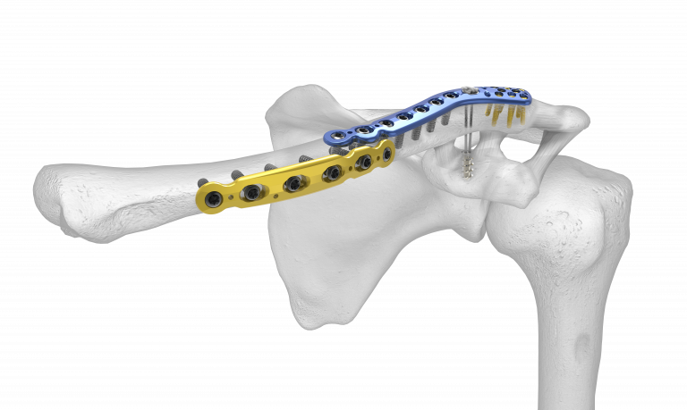 Clavicle Plate with Acu-Sinch Anterior Plate | Acumed