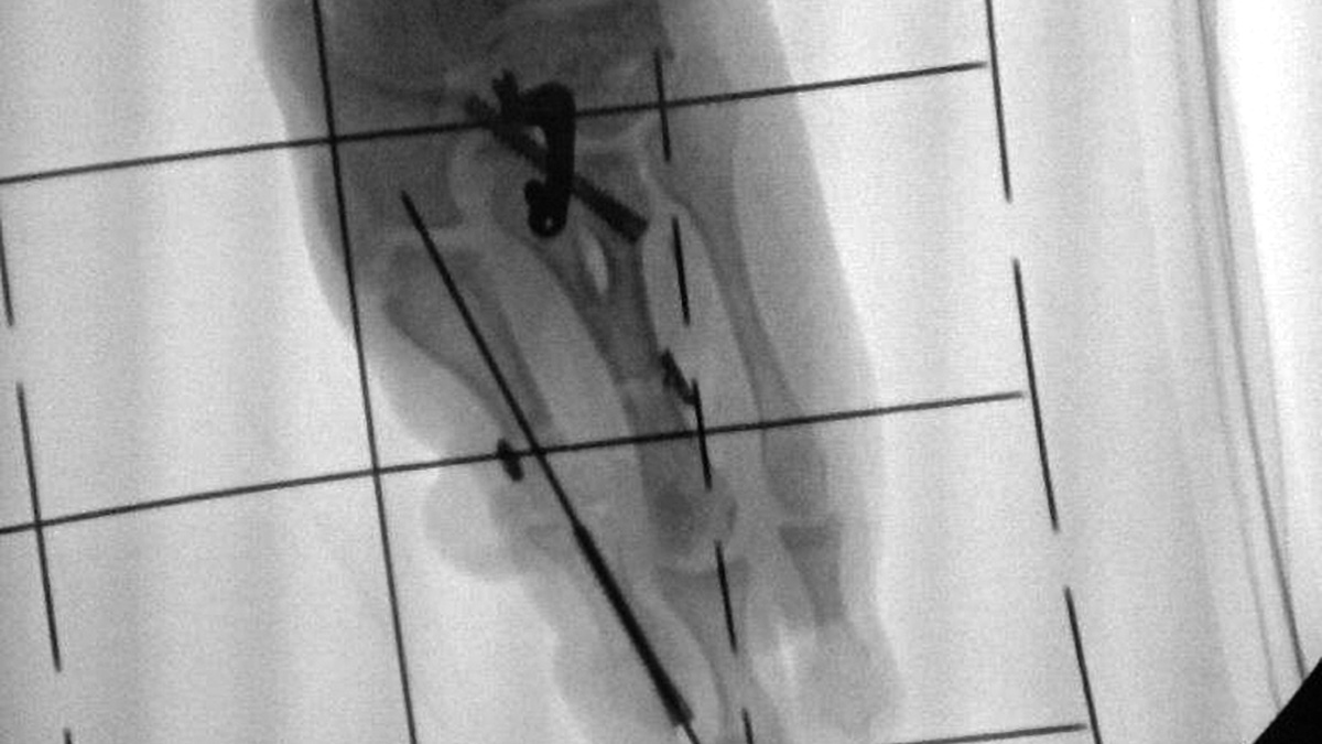 Claw foot deformity, Dorsal view | Acumed