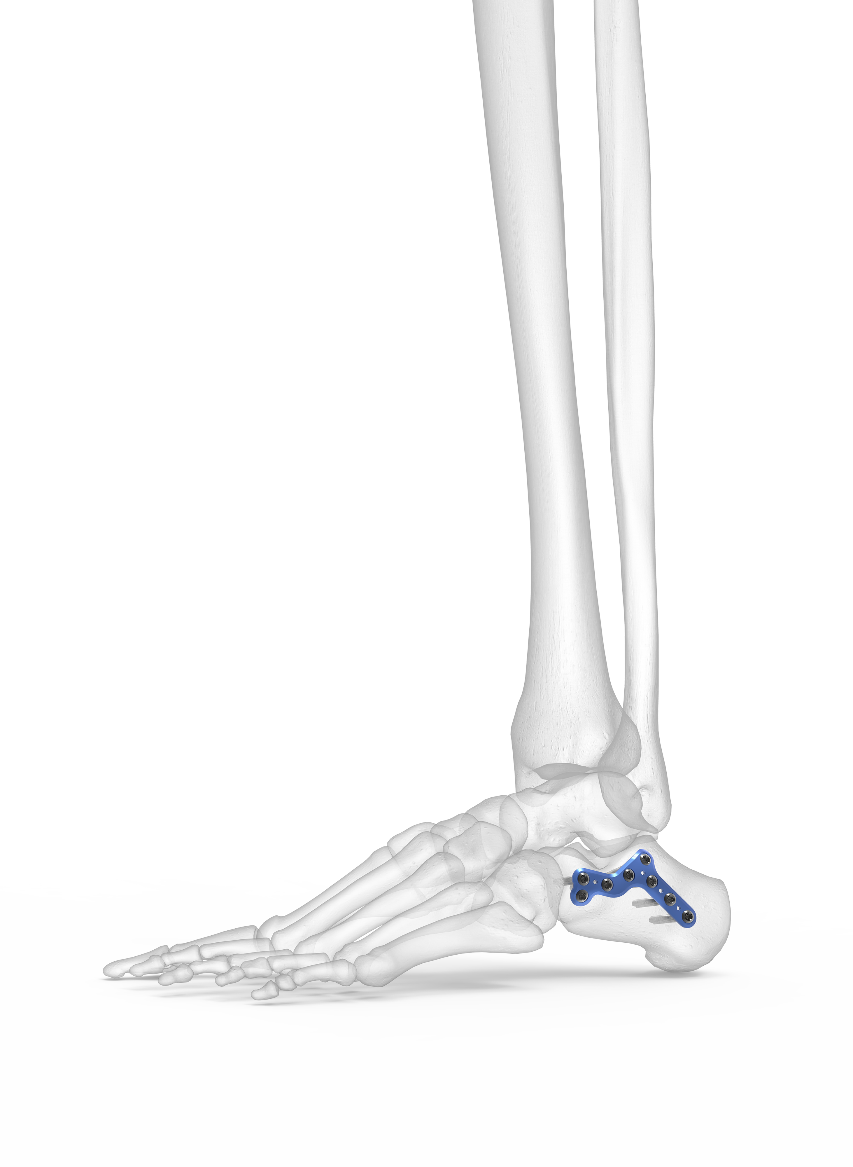 Calcaneal Plating System | Acumed