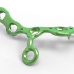 Elbow Plating System | Acumed