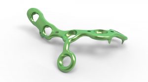 Elbow Plating System | Acumed