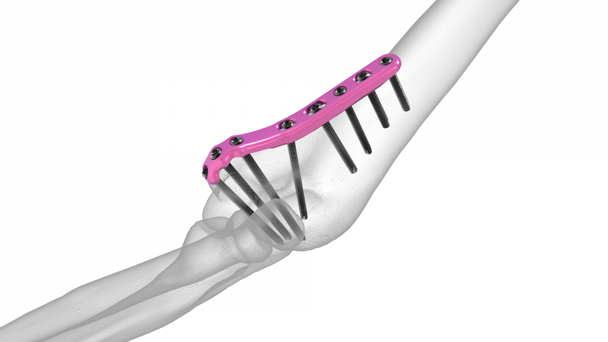 Medial Column Plate | Acumed