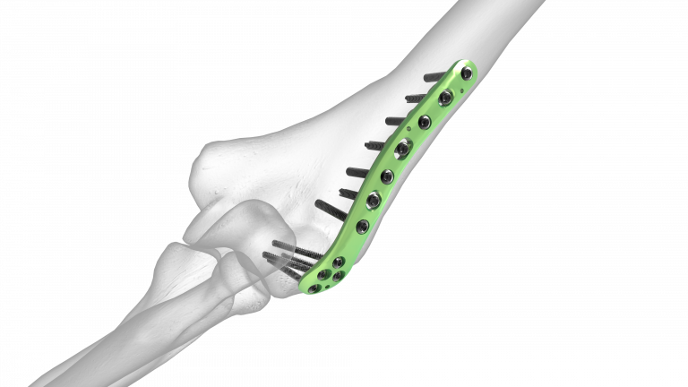 Posterolateral Plate | Acumed