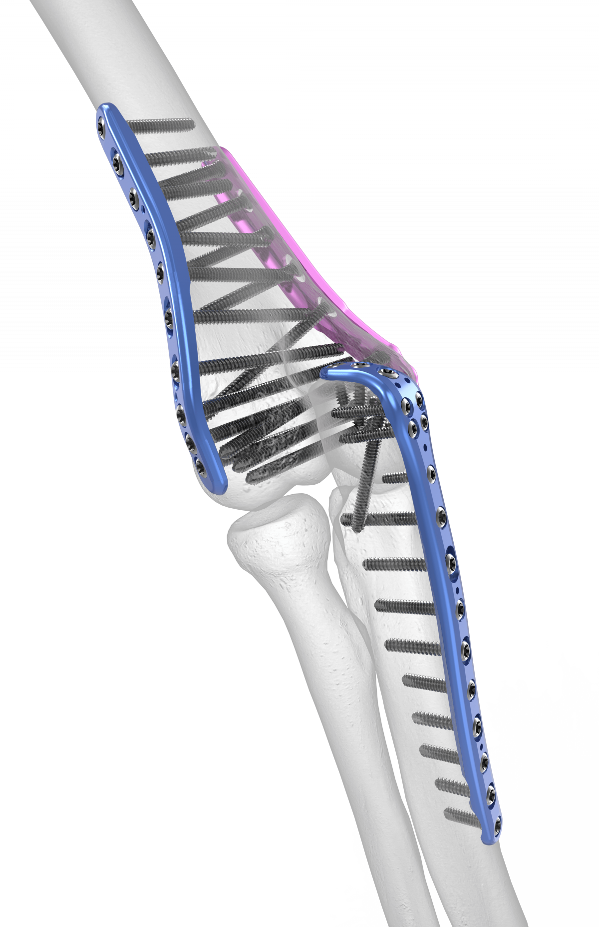 Elbow Plating System Plates | Acumed