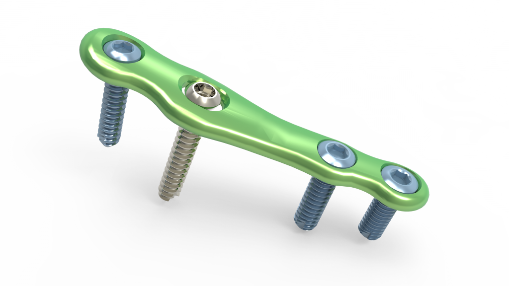 Forefoot-Midfoot Plating System | Acumed
