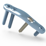 Forefoot-Midfoot Plating System | Acumed