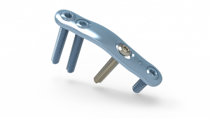 Forefoot-Midfoot Plating System | Acumed