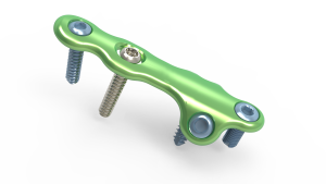 Forefoot-Midfoot Plating System | Acumed