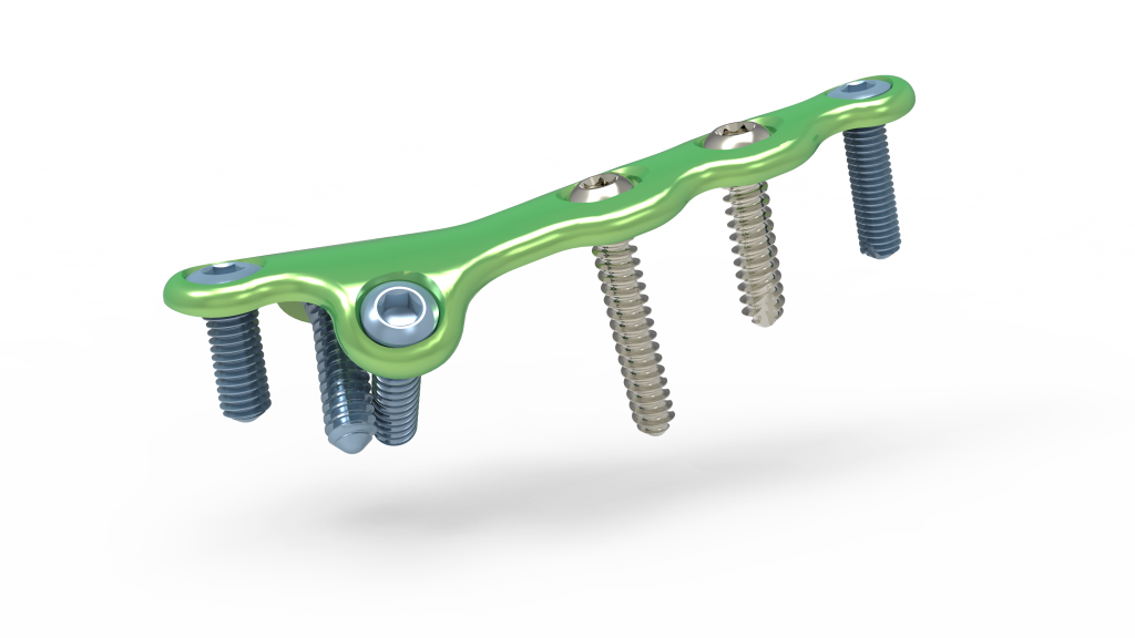 Forefoot-Midfoot Plating System | Acumed