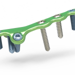 Forefoot-Midfoot Plating System | Acumed