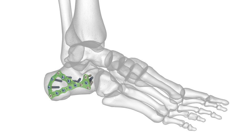 Calcaneal Plating System | Acumed