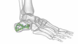Calcaneal Plating System | Acumed