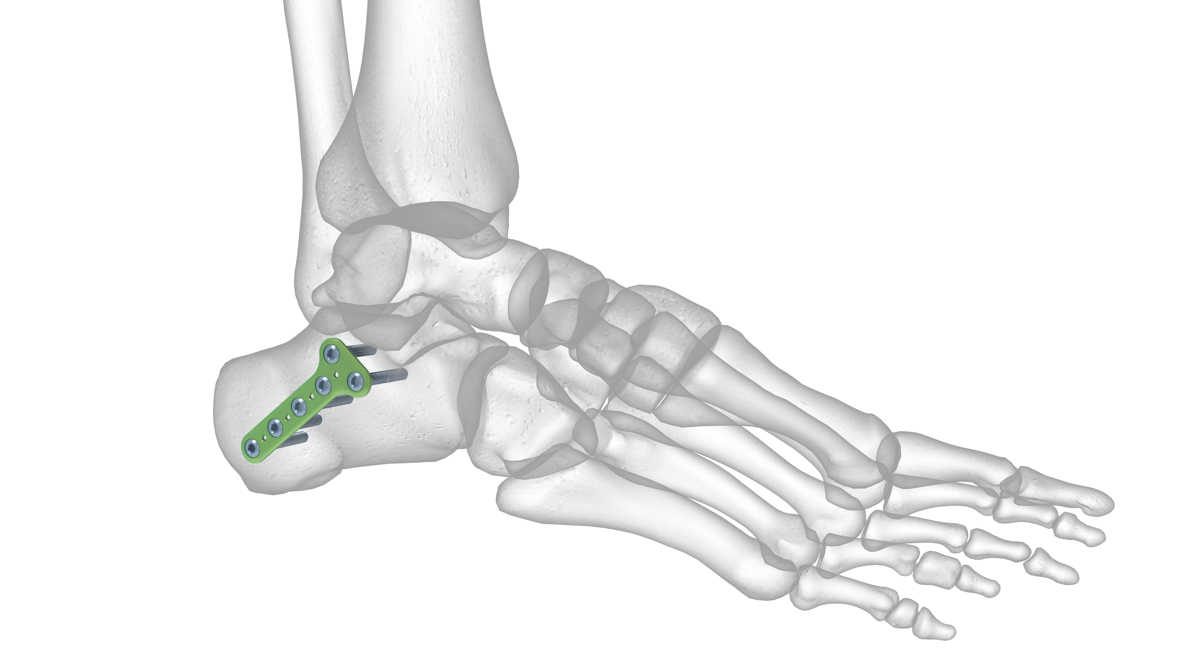 Calcaneal Plating System | Acumed