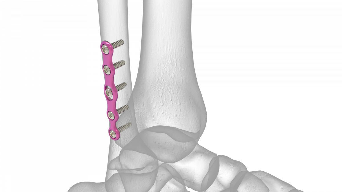 Congruent Glide Plate | Acumed