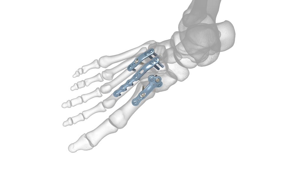 Forefoot-Midfoot Plating System | Acumed