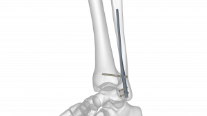 Fibula Rod System | Acumed