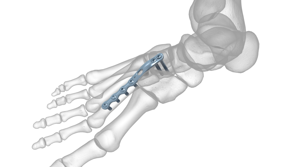 Forefoot-Midfoot Plating System | Acumed