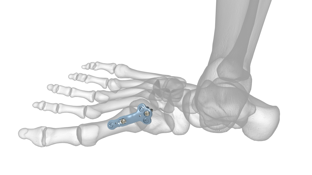 Forefoot-Midfoot Plating System | Acumed