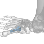 Forefoot-Midfoot Plating System | Acumed