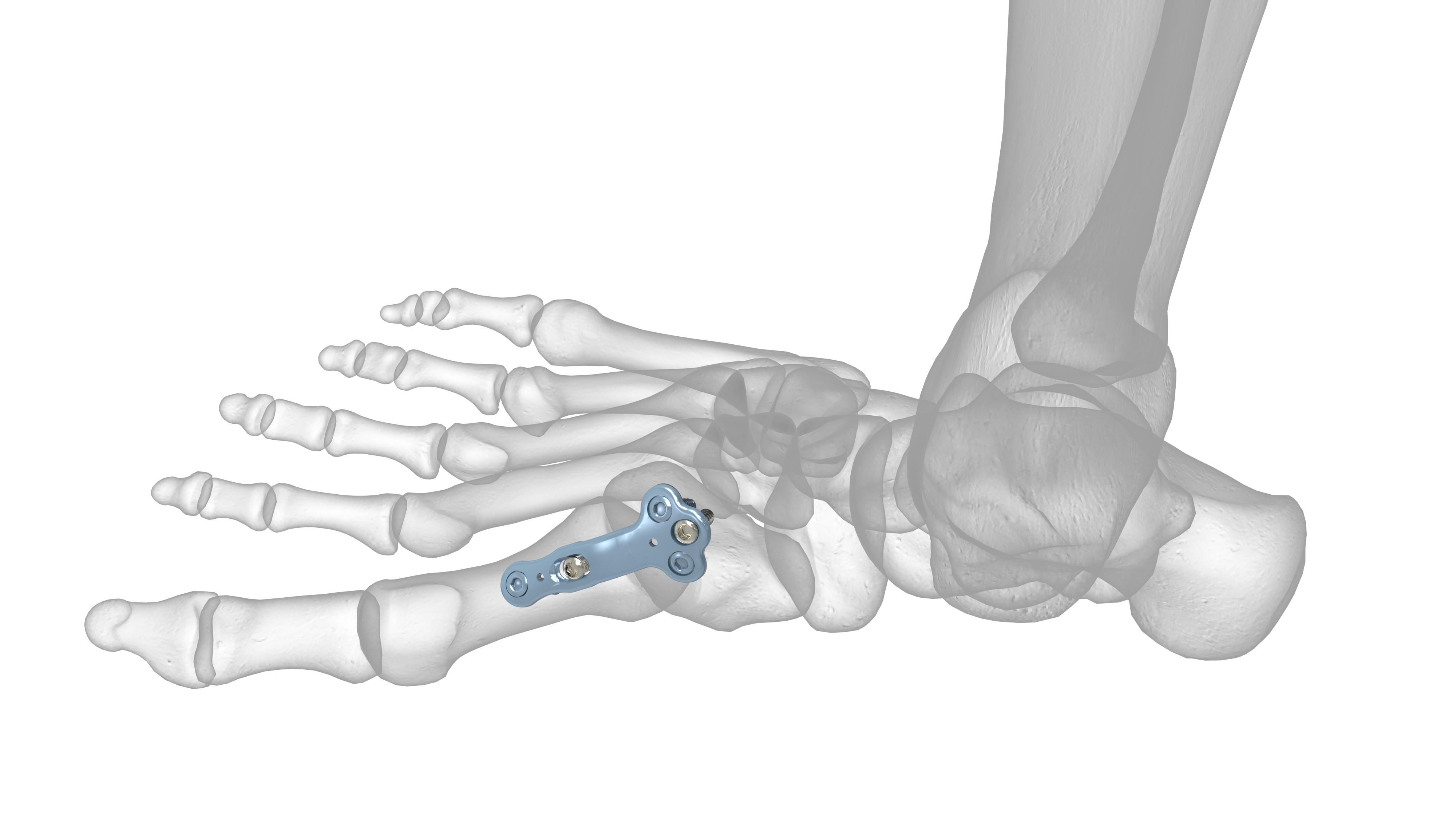 First TMT Plate | Acumed