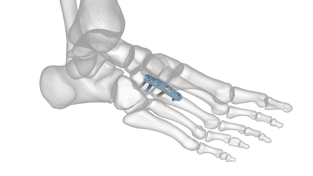 Forefoot-Midfoot Plating System | Acumed