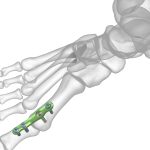 Forefoot-Midfoot Plating System | Acumed