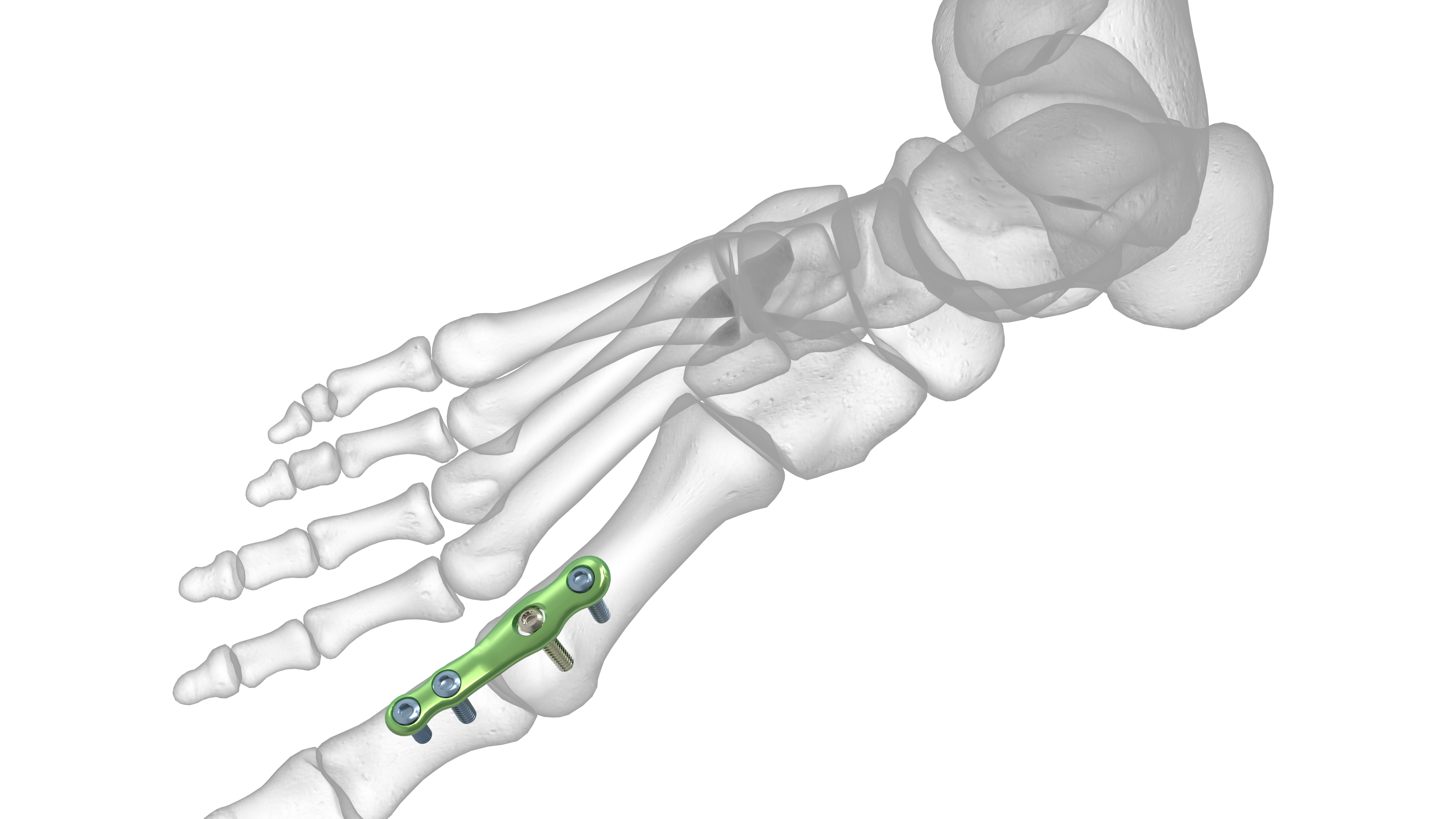 Locking Dorsal MTP Plate | Acumed